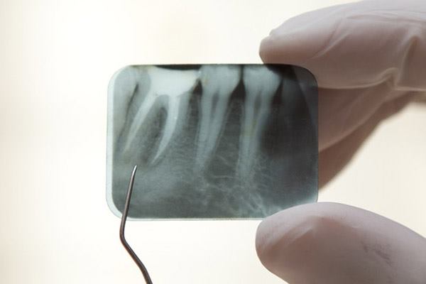 Making New Teeth From One's Own Gums